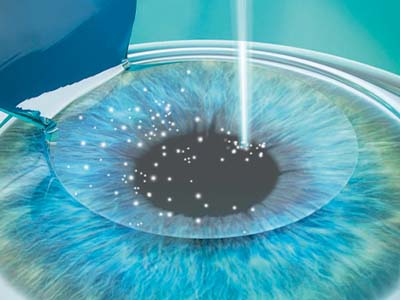Femto LASIK - laserska operacija dioptrije | Očesni center Morela